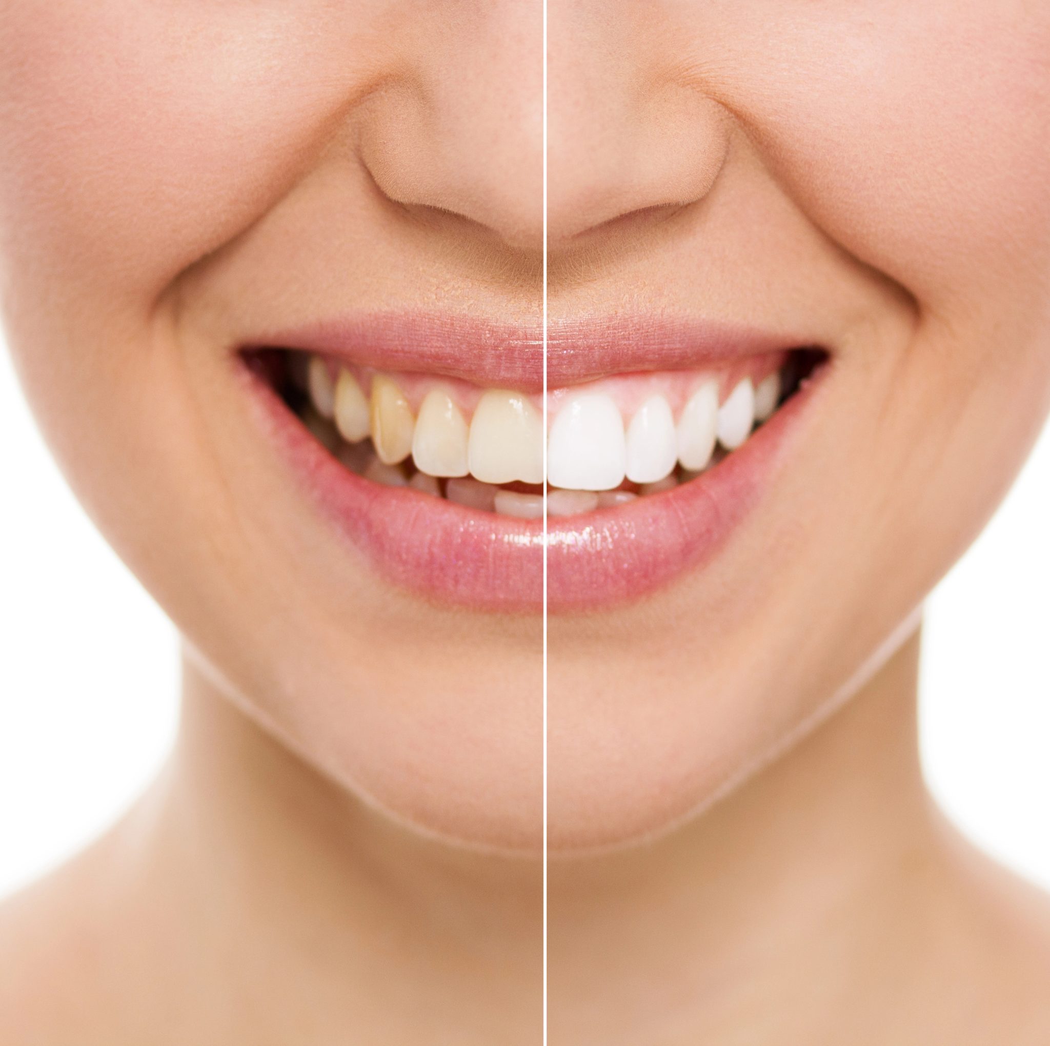 Is Professional Teeth Whitening Right for Your Smile in San Antonio ...